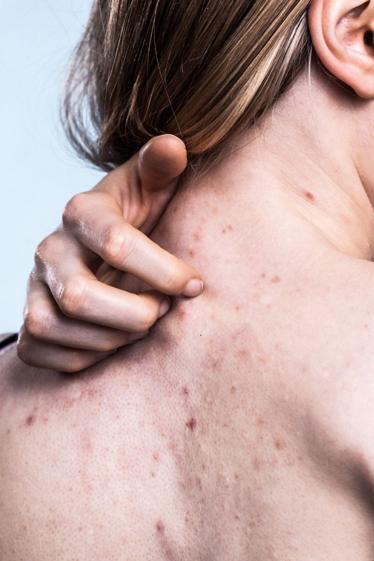 Why Do You Get Back Acne? – INJA Wellness